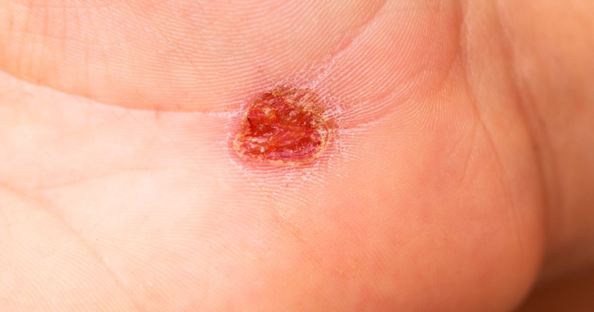 Tratamento de Infecção Localizada em Feridas